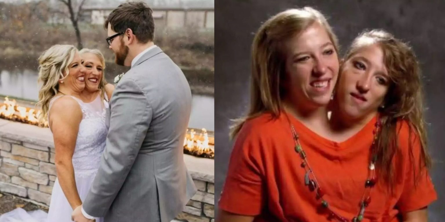 Famous Conjoined Twins Now Married