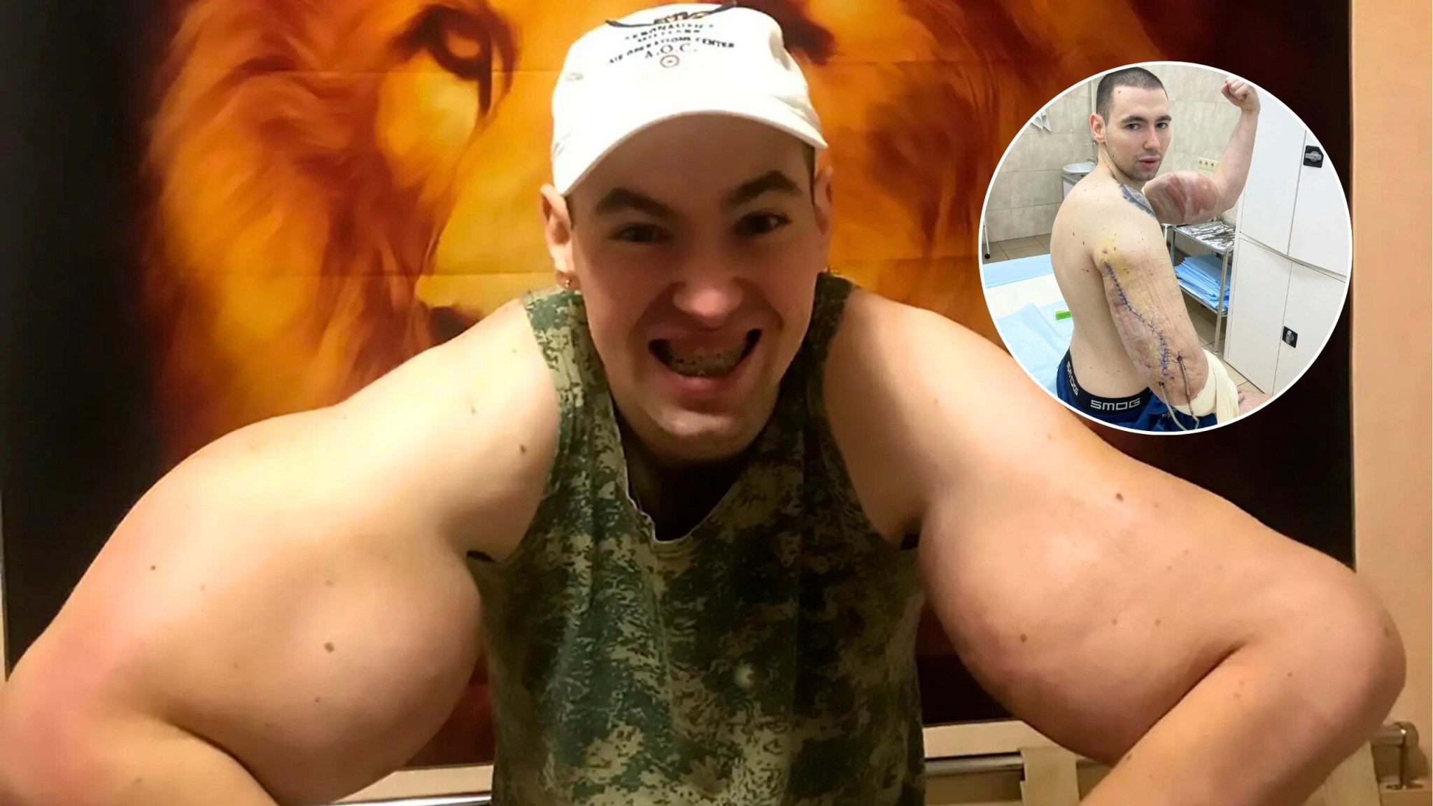 Russian ‘Popeye’ Who Injected His Biceps May Now Lose Both Arms to ...