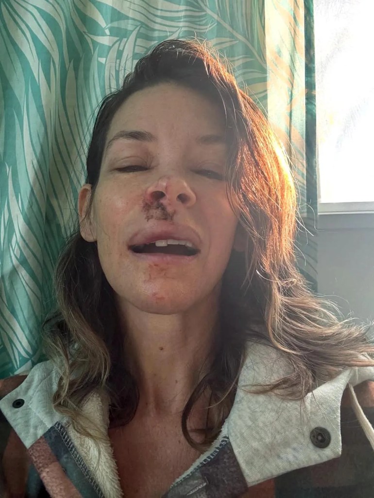 Evangeline Lilly Reveals Brain Damage Months After Beach Accident